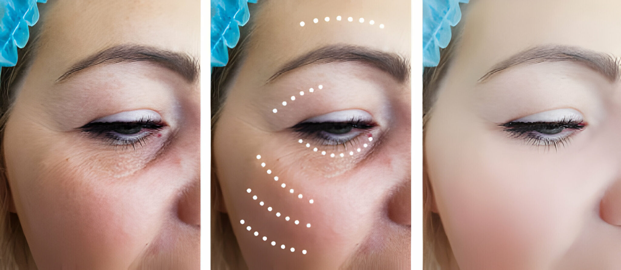 Exploring the Different Types of Lower Facelift Techniques